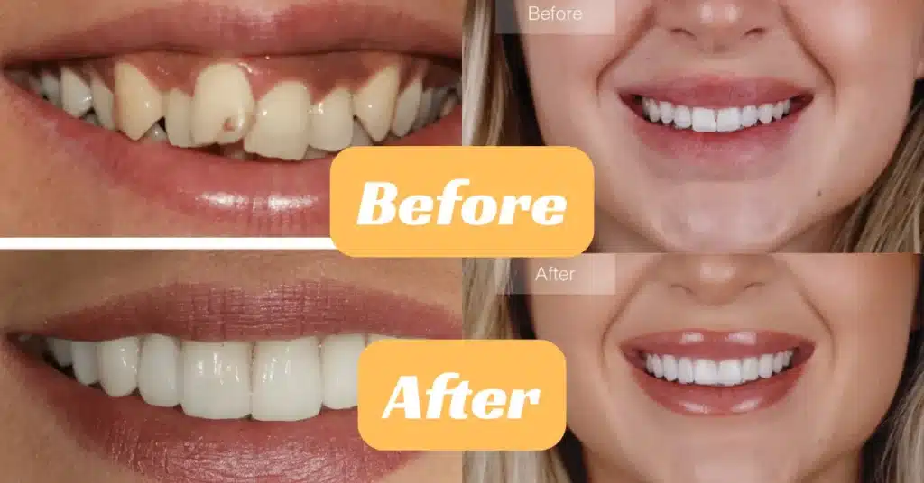 Veneers Before and After: See the Amazing Smile Makeovers