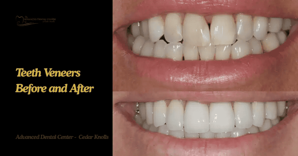 Veneers Before and After: See the Amazing Smile Makeovers