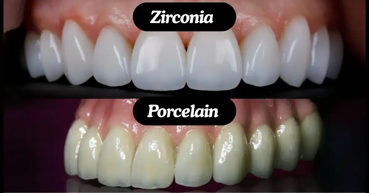 Zirconia vs Porcelain Crowns: Which Is Better?